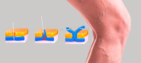 Cirurgia de Varizes (Flebectomia) - Vascular SP